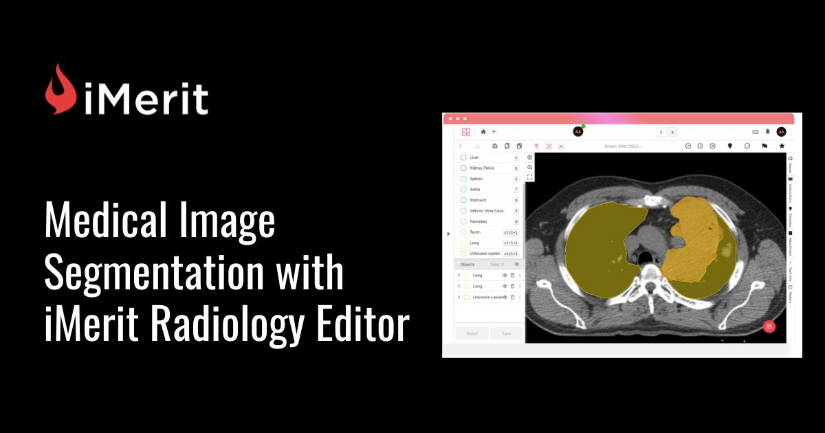 Medical Image Segmentation with iMerit Radiology Editor - iMerit